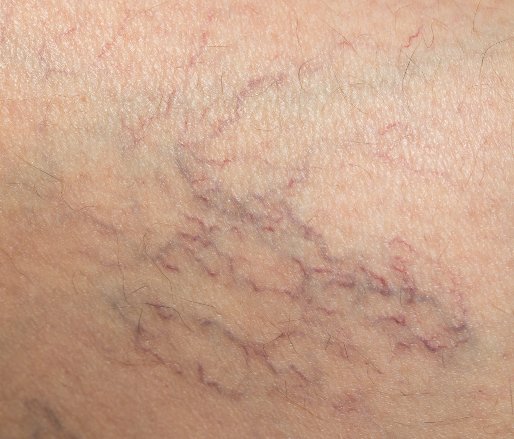 veins on the skin. close - Colorado Laser Clinic PC