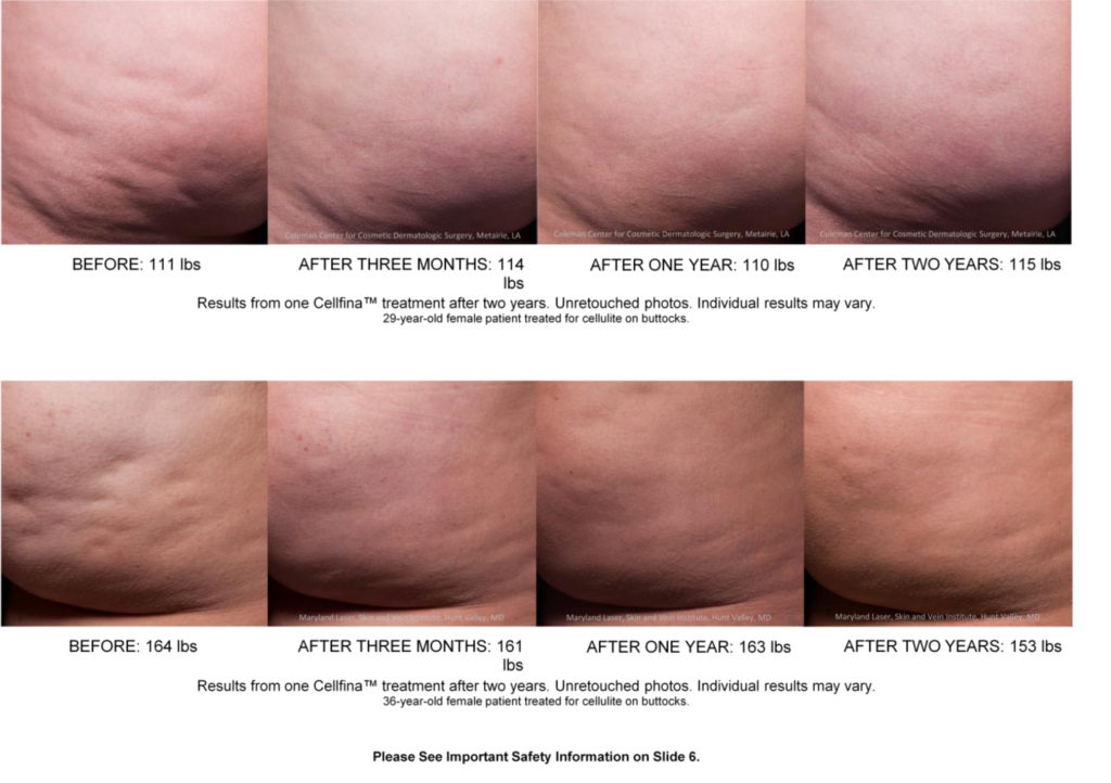 Pictures 2 Cellfina - Colorado Laser Clinic PC